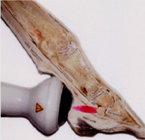 Comment traiter une tendinite avec efficacité et sans effet secondaire ...