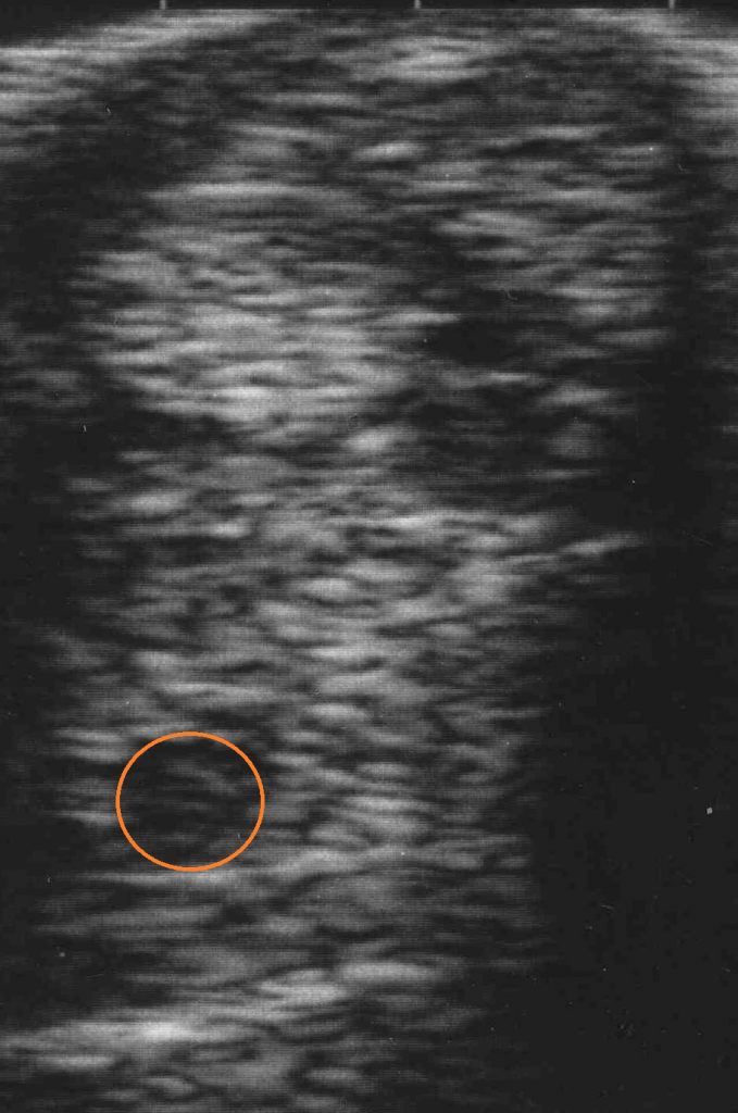 Comment traiter une tendinite avec efficacité et sans effet secondaire ...