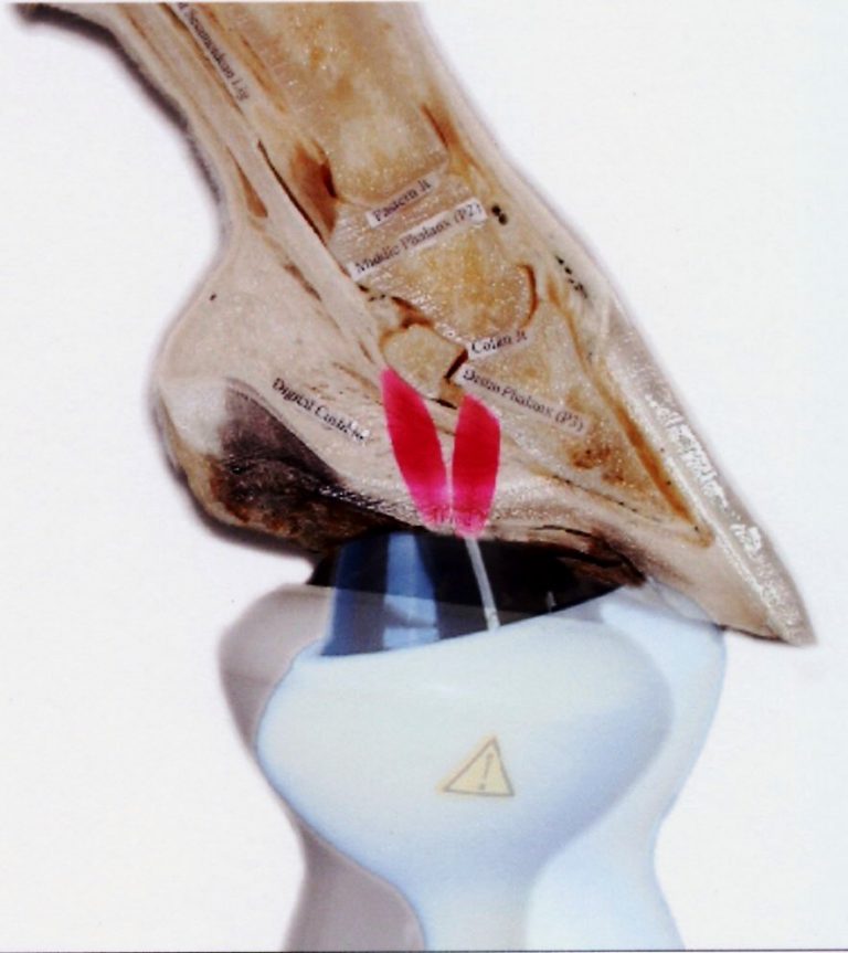 Comment traiter une tendinite avec efficacité et sans effet secondaire ...